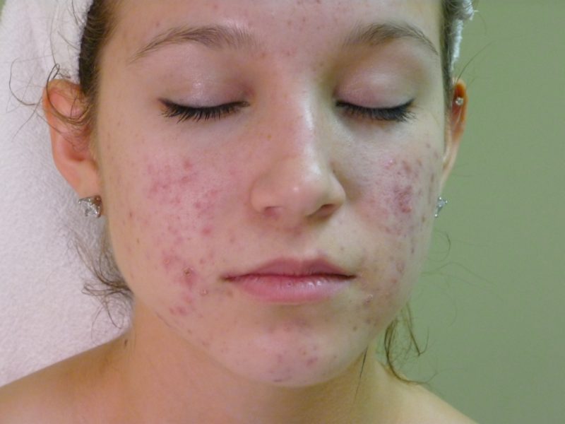 9 Face Mapping Acne Spots And What Every Acne Spot Means?